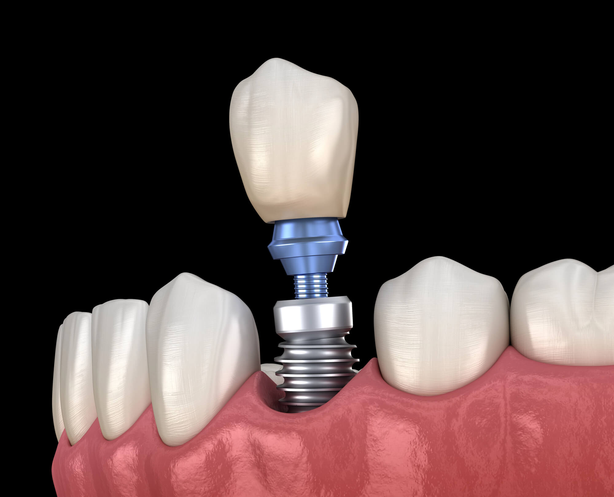 A Step-by-Step Guide to the Dental Implant Process